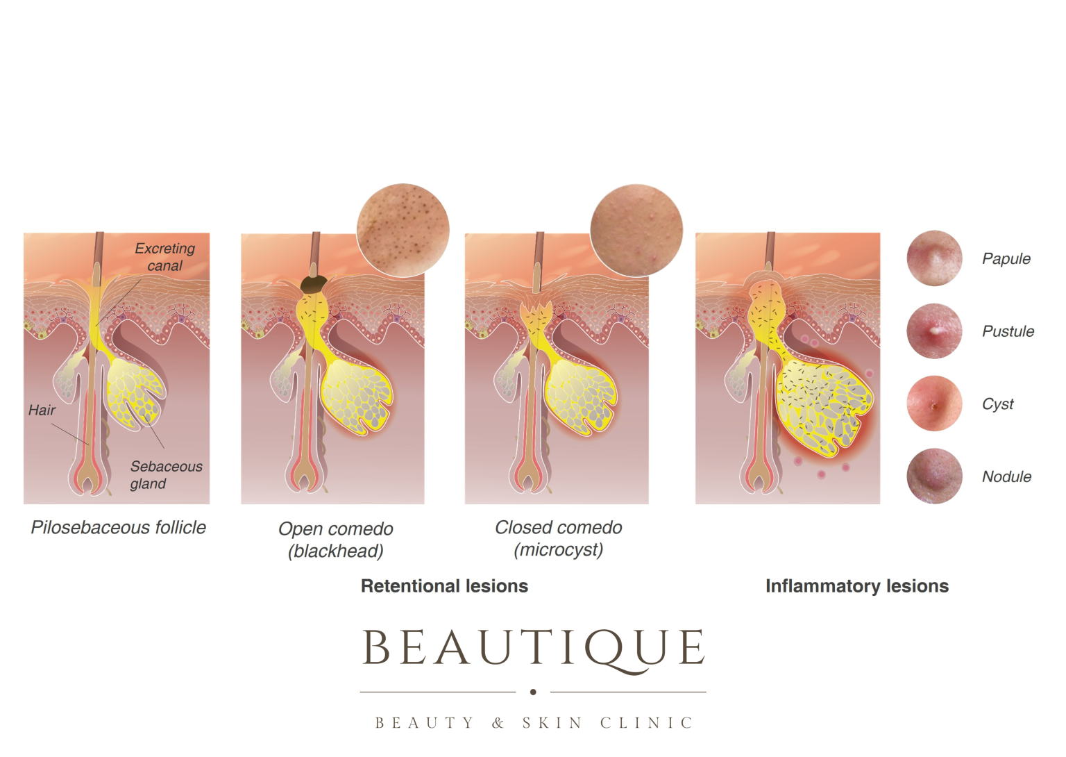 acné, onzuiverheden en acnélittekens - Beautique Beauty & skin clinic ...